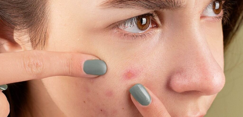 Quando si può schiacciare un brufolo? - Santagostino Magazine