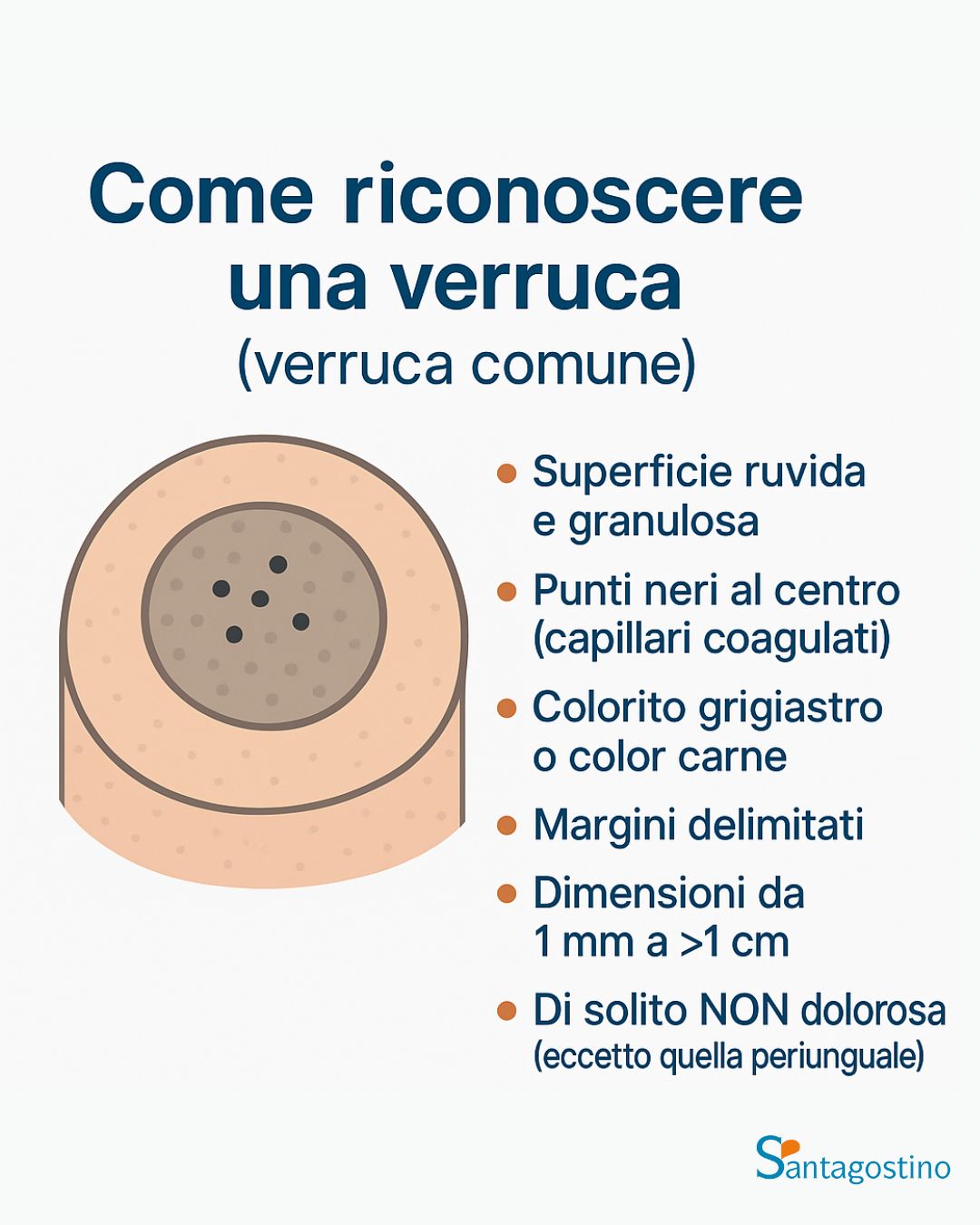 Le verruche alle mani - Santagostino Magazine